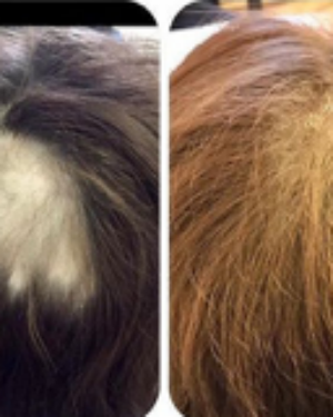 Laser Hair Retention - Hair Loss Specialist Clinic